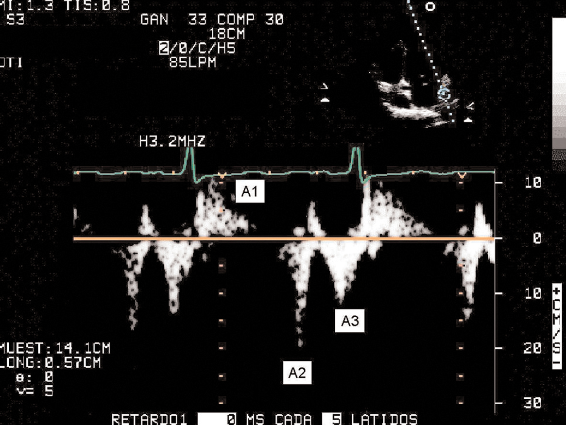 Assessment of Left Atrial Wall Velocities by Pulsed Wave Tissue Doppler ...