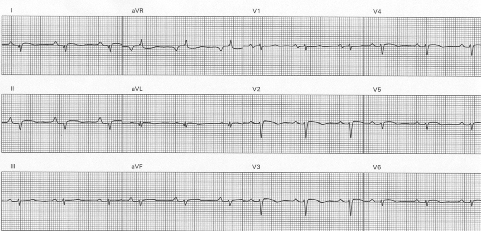 Noncompaction of the Ventricular Myocardium | Revista Española de ...