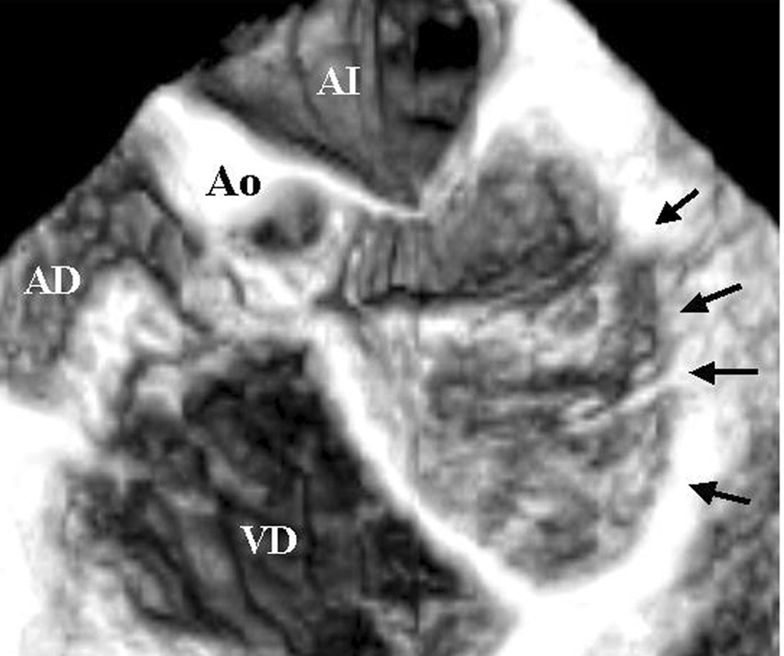 Noncompaction of the Ventricular Myocardium | Revista Española de ...