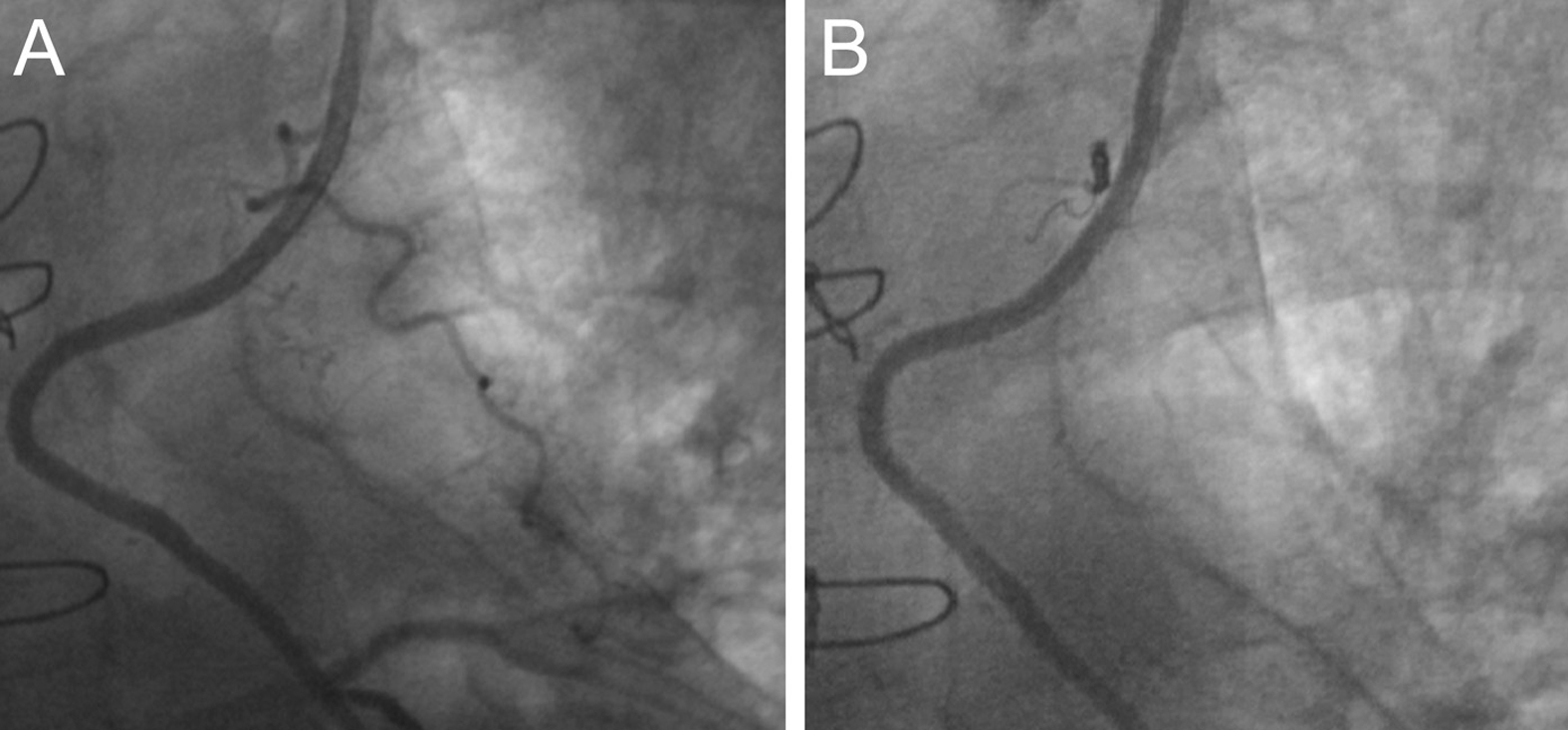 Percutaneous Occlusion With Coils of Coronary Artery Fistulas in Adults ...