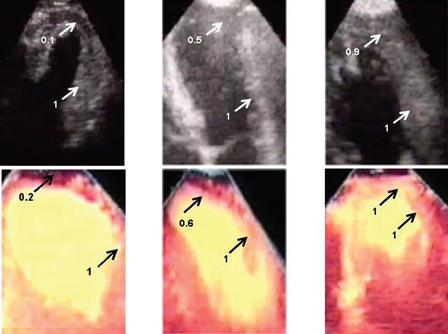 Study of Post-Infarction Coronary Perfusion Using Quantitative Analysis ...