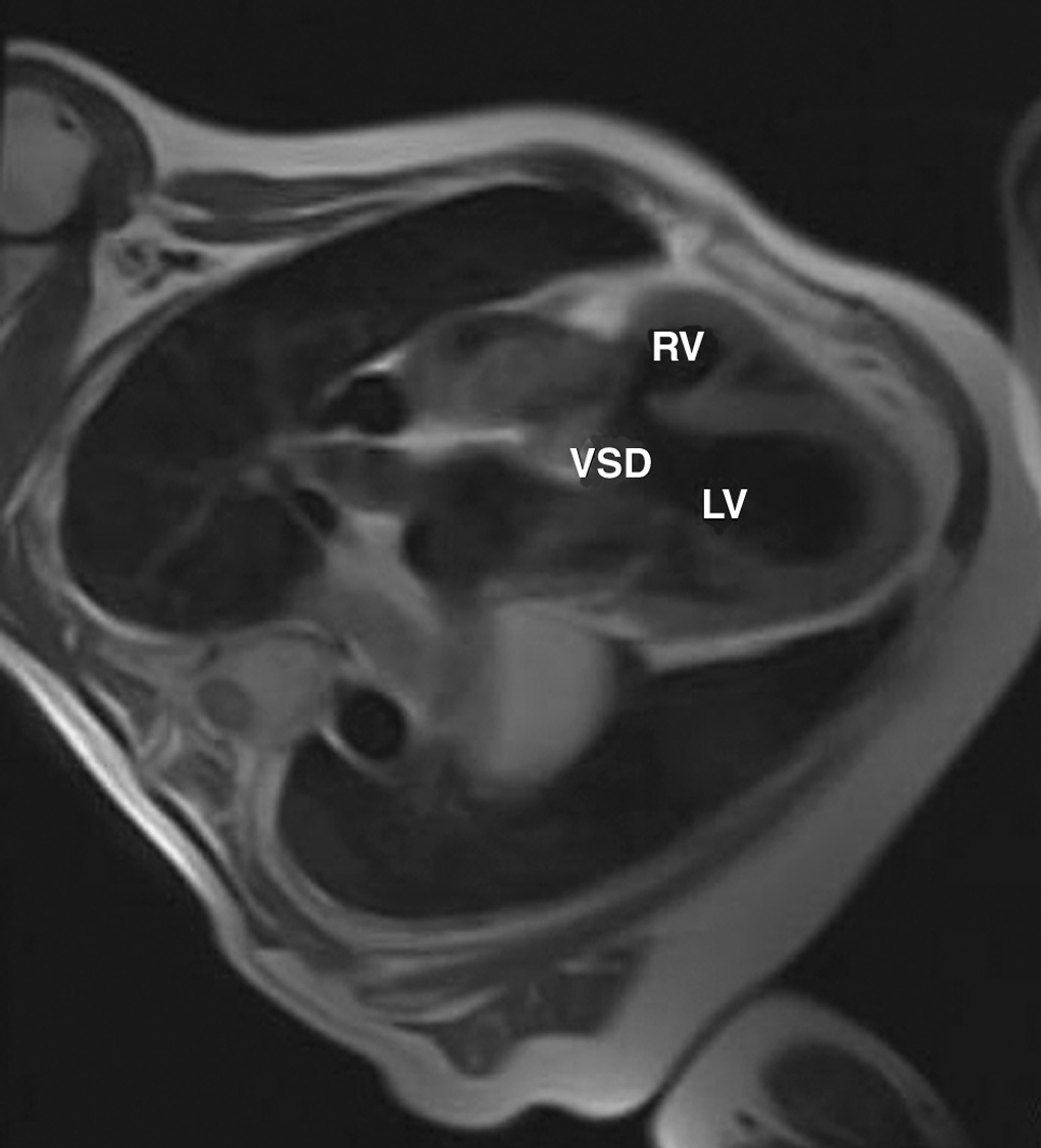 An Adult With a Double-Chamber Right Ventricle | Revista Española de ...