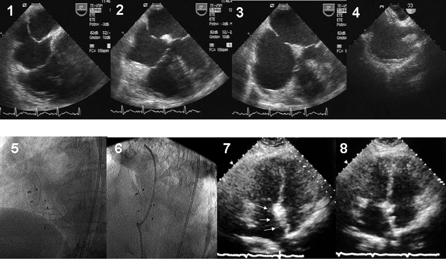 Percutaneous Treatment of Atrial Septal Aneurysm | Revista Española de ...