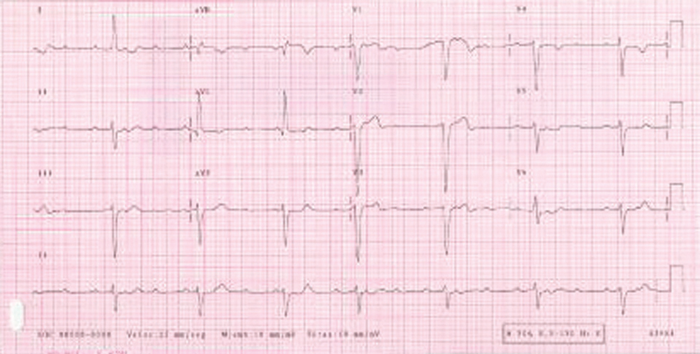 Complete Atrioventricular Block Secondary to Pulmonary Embolism ...