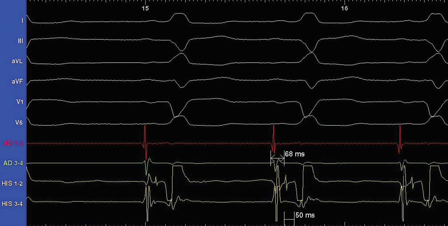 Complete Atrioventricular Block Secondary to Pulmonary Embolism ...