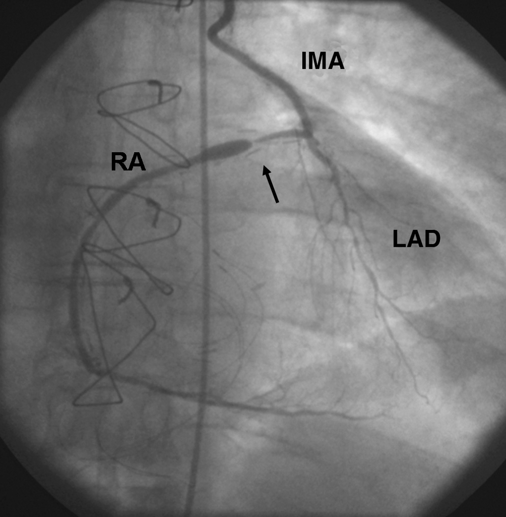 Percutaneous Intervention to a Radial Coronary Artery Graft. Initial ...