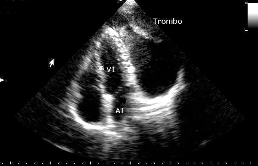 Aneurism of the Left Atrial Appendage | Revista Española de Cardiología