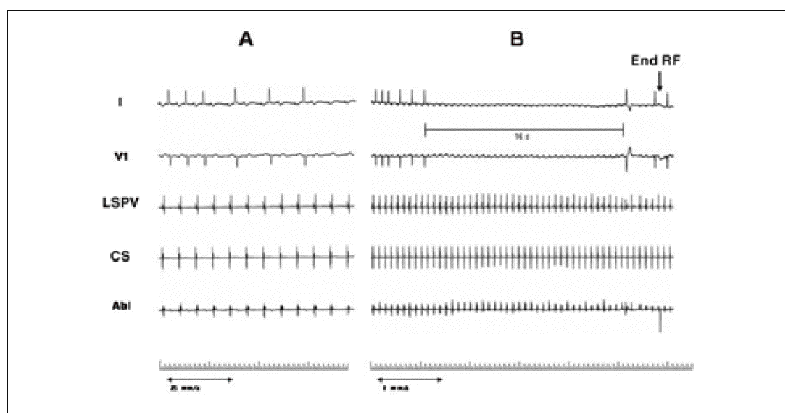 Reflex Transient Atrioventricular Block During Atrial Fibrillation ...