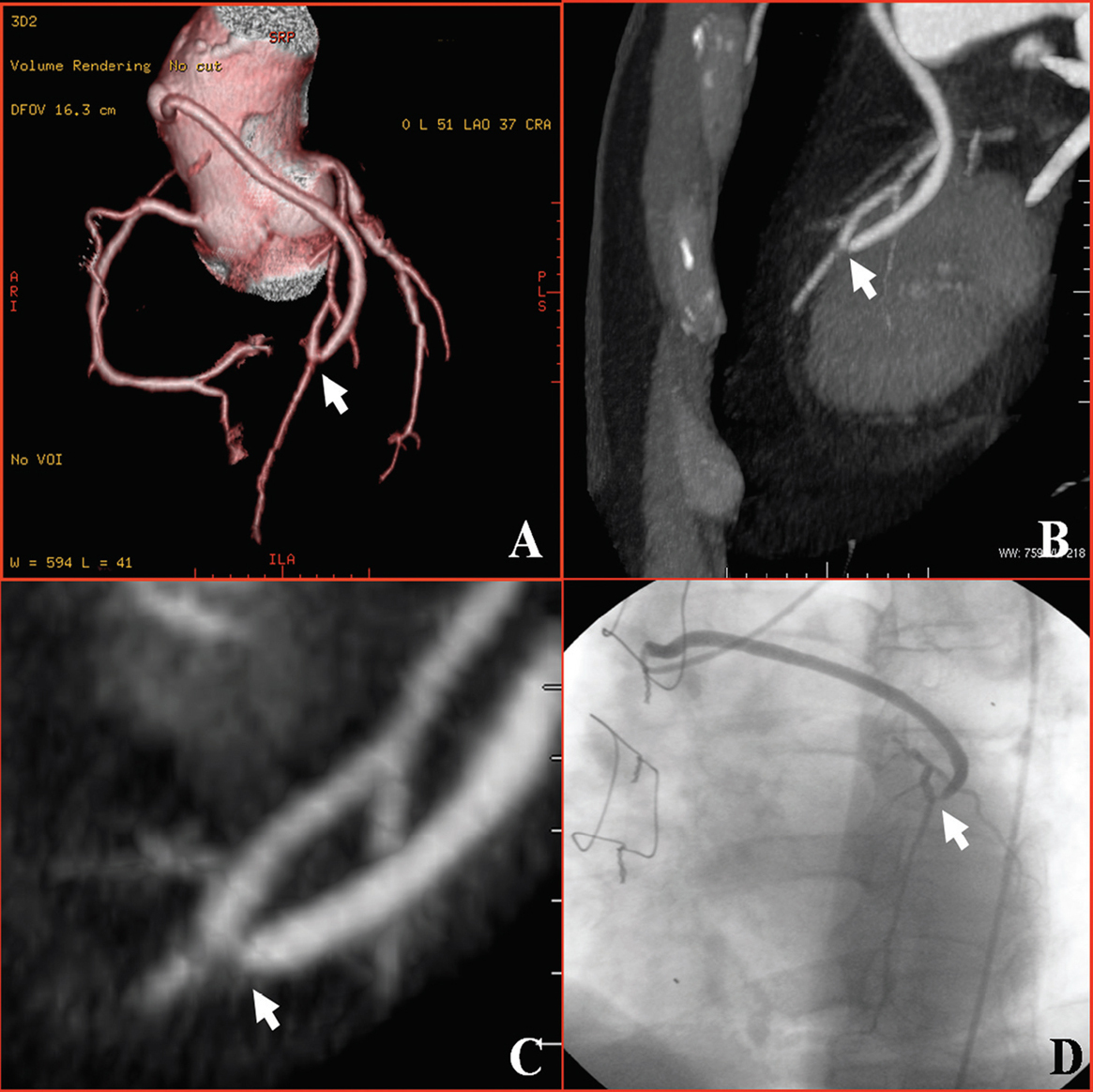 Non-Invasive Assessment of Coronary Artery Bypass Grafts by Computed ...