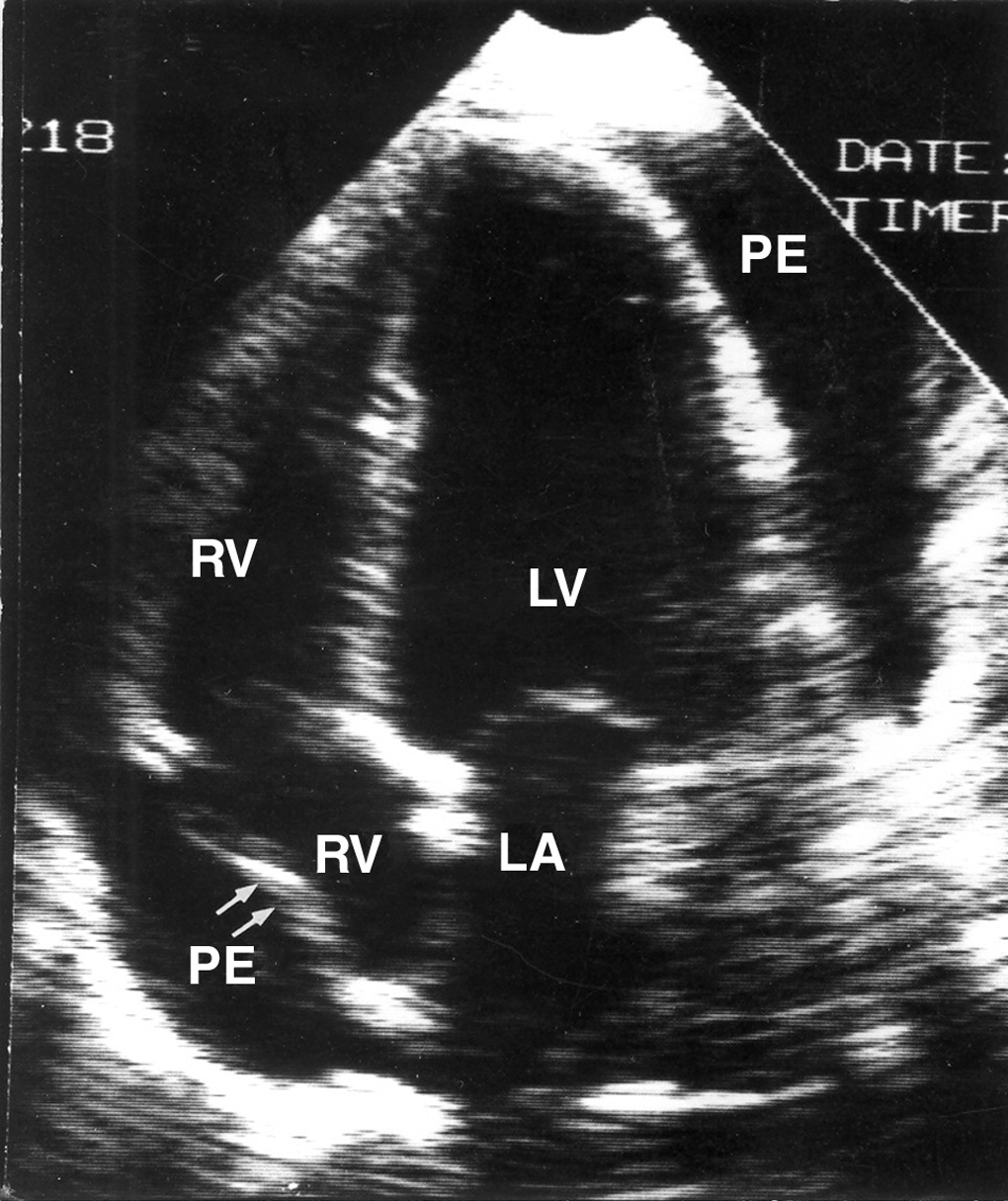 Diagnosis and Management of Acute Pericardial Syndromes | Revista ...