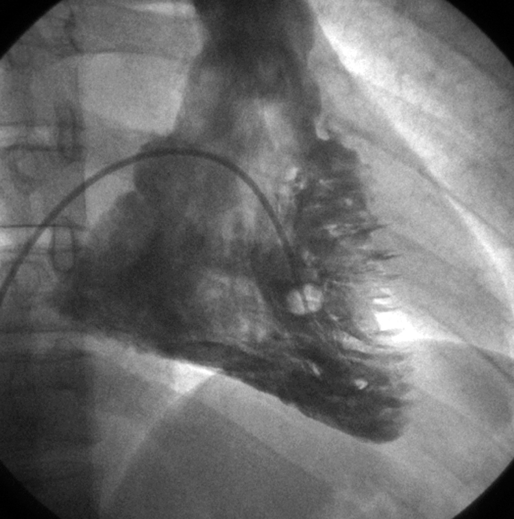 Unusual Electrocardiographic Presentation of Arrhythmogenic Right ...