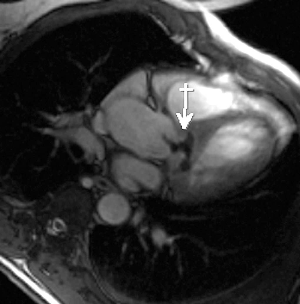 Fibrocalcific Septal Mass With Subaortic Membrane | Revista Española de ...