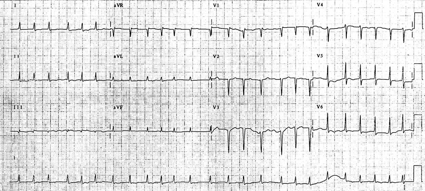 Bidirectional Ventricular Tachycardia due to Digitalis Poisoning