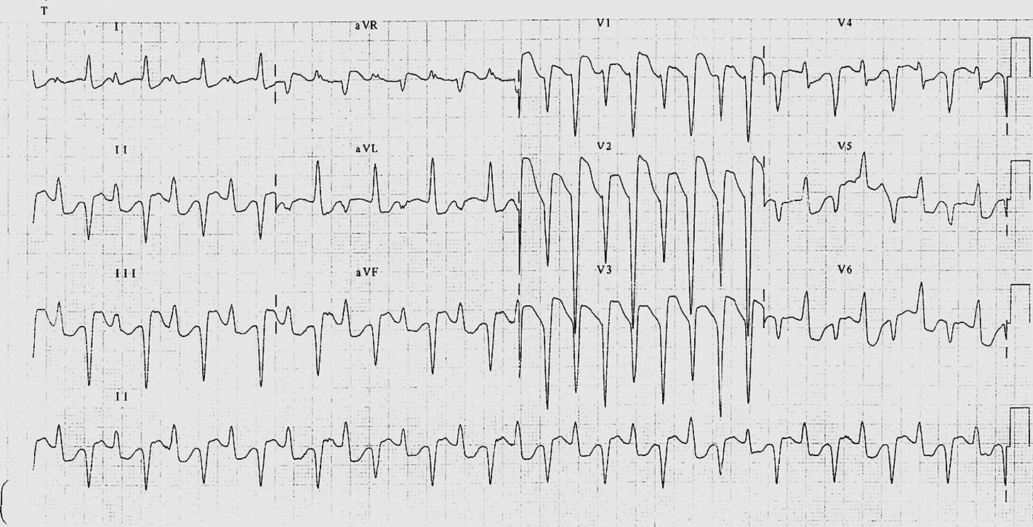 Bidirectional Ventricular Tachycardia due to Digitalis Poisoning ...