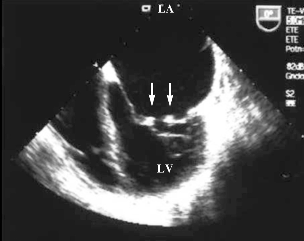 Severe Mitral Regurgitation in Libman-Sacks Endocarditis. Conservative ...