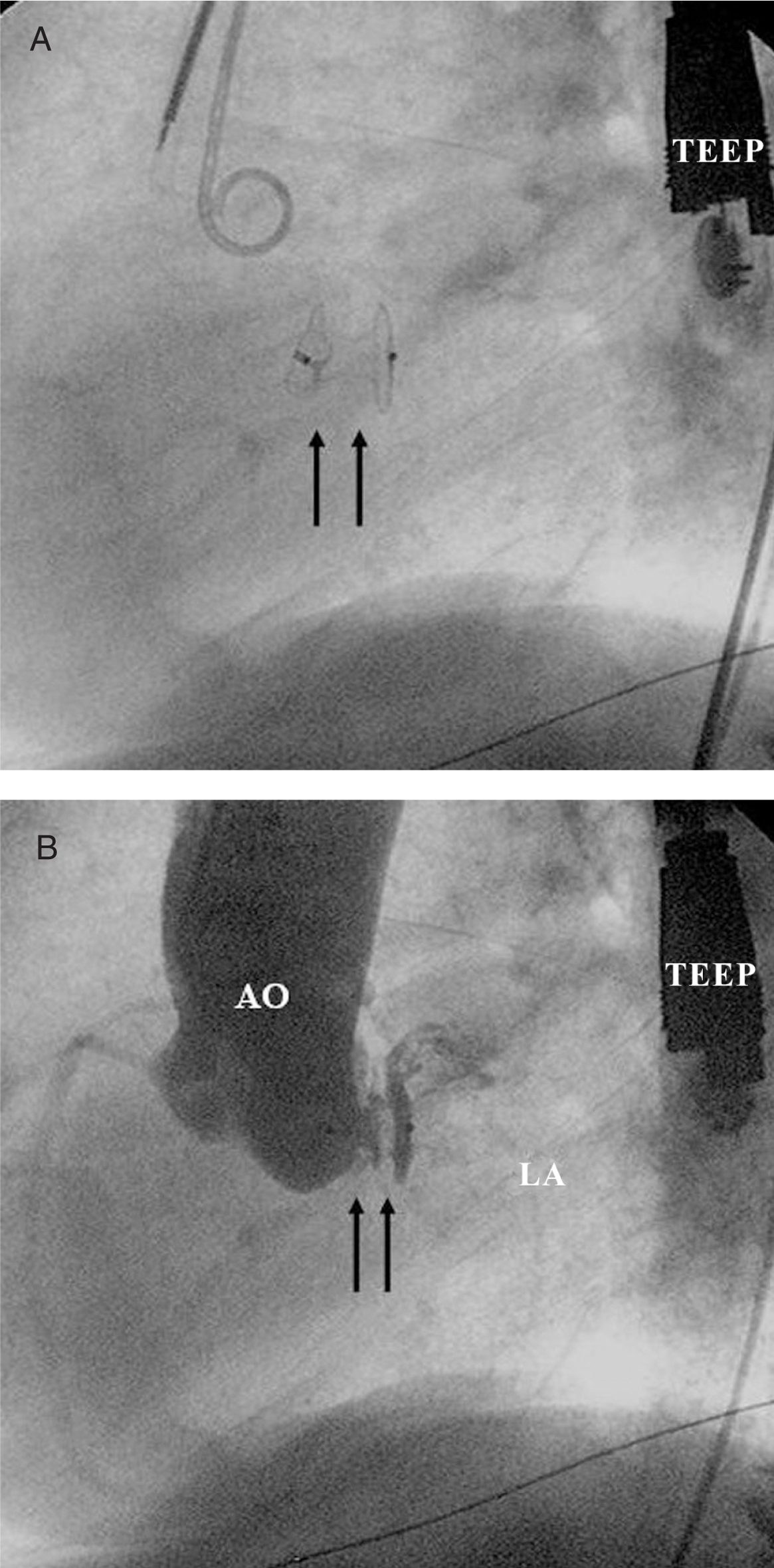 Transcatheter Closure of Aorto-Left Atrial Fistula Using an Amplatzer ...