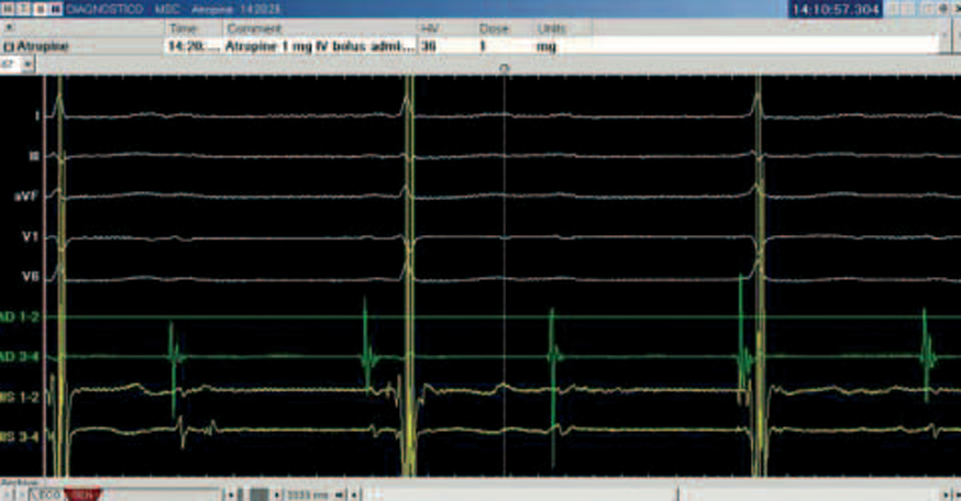Atrioventricular Block Induced by Exercise is Not Always Infrahisian ...