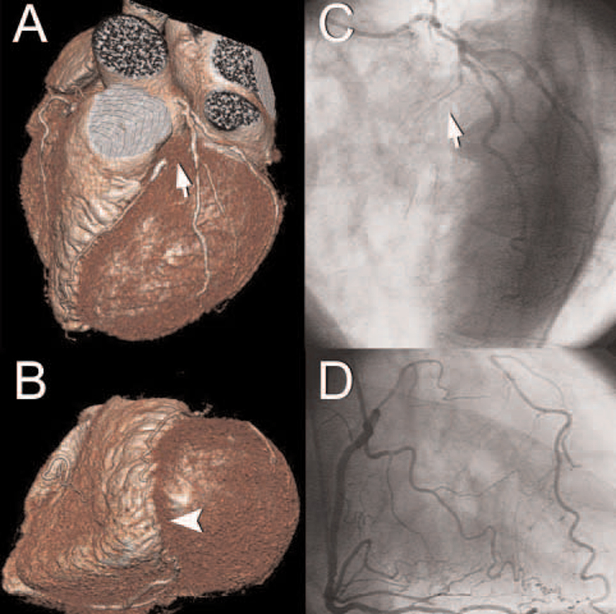 Multislice Computed Tomography Coronary Angiography: Prime Time ...