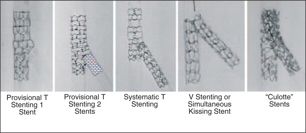 Bifucartion Lesions: The Simpler, the Better | Revista Española de ...