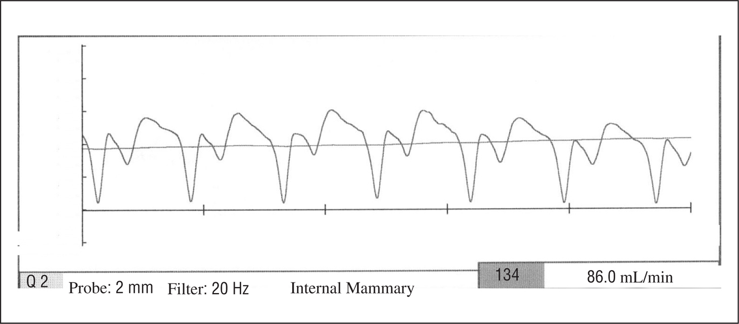 Off-Pump Coronary Artery Bypass Grafting and Other Minimally Invasive ...