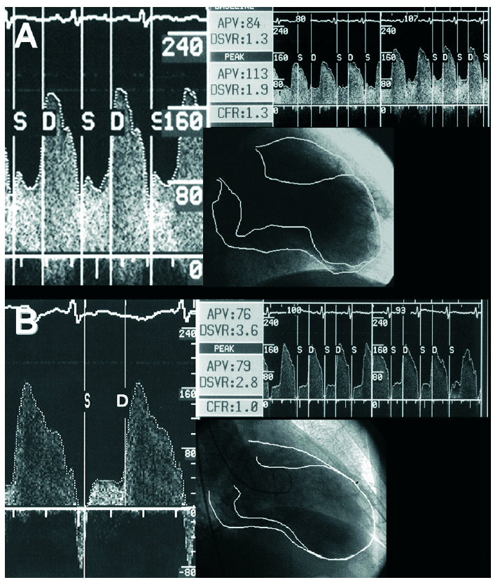 Relationship Between Coronary Flow and Viability in Patients With ...