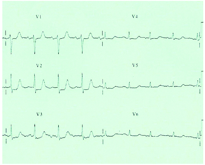 Cardiac Cephalgia: an Underdiagnosed Condition? | Revista Española de ...