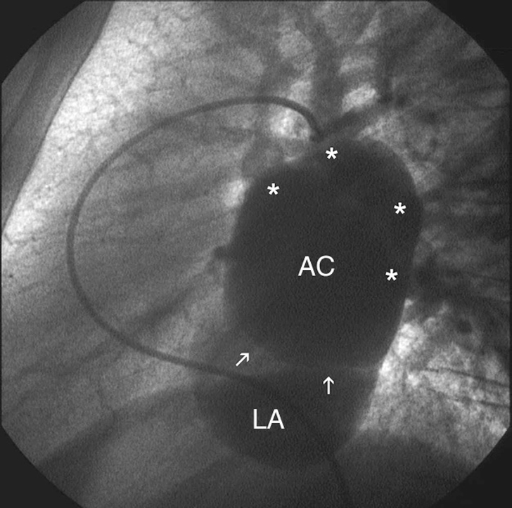 Cor Triatriatum in Adults: Intracardiac Echocardiography | Revista ...