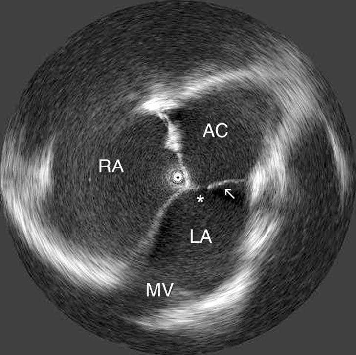 Cor Triatriatum in Adults: Intracardiac Echocardiography | Revista ...