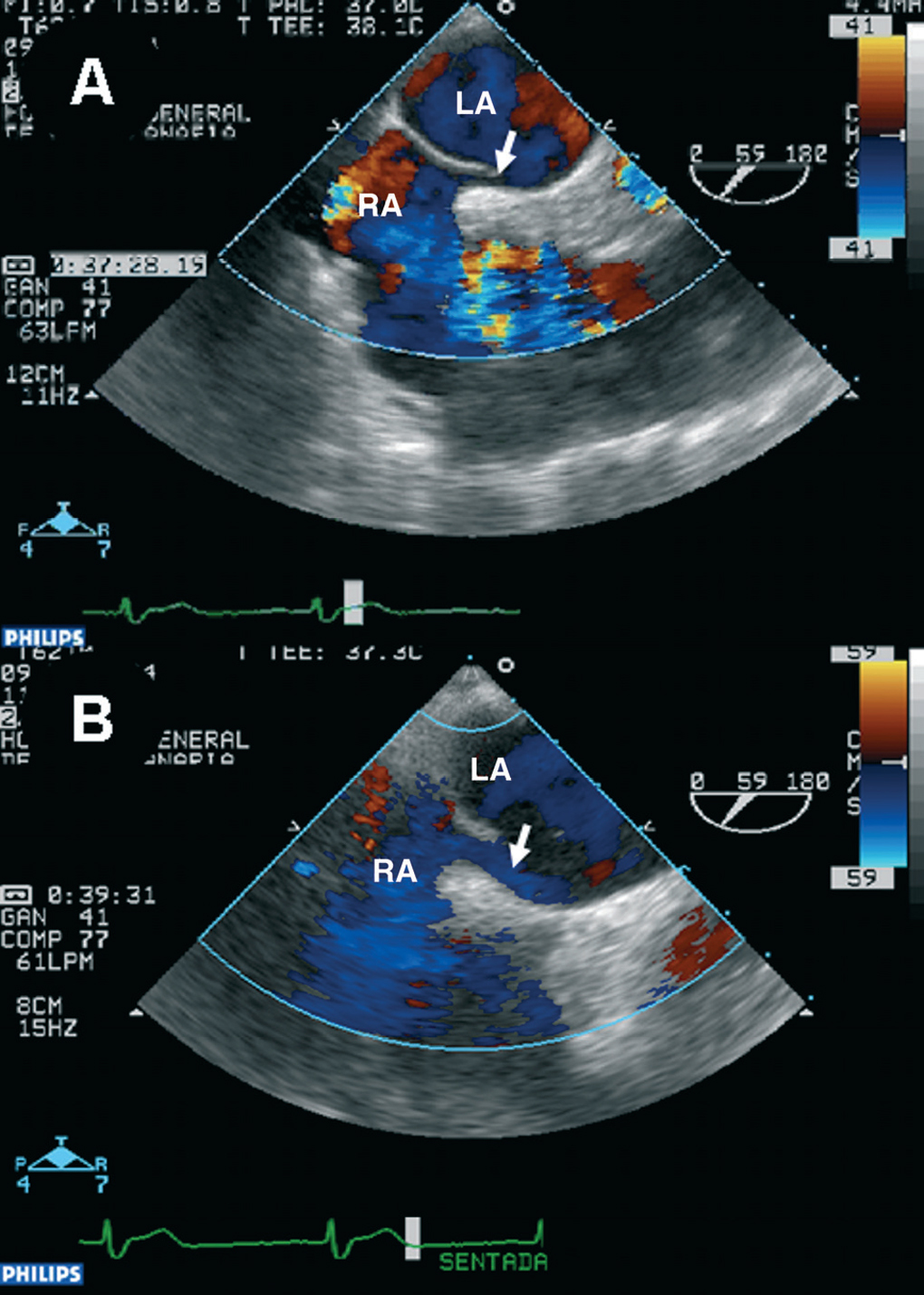 Transcatheter Closure of Patent Foramen Ovale in Patients With ...