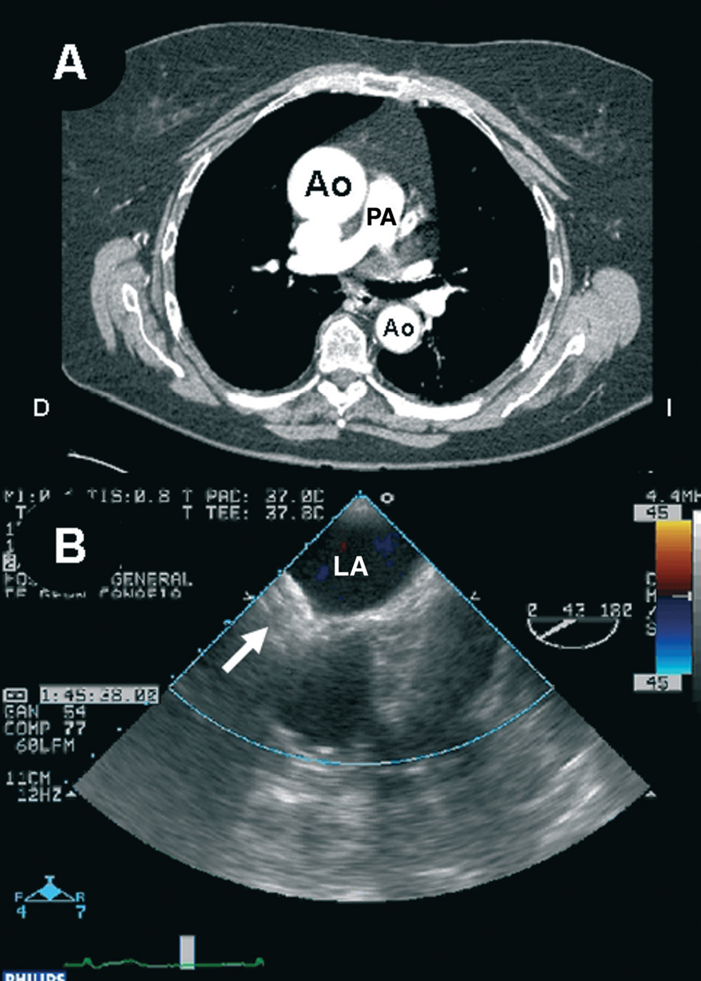Transcatheter Closure of Patent Foramen Ovale in Patients With ...