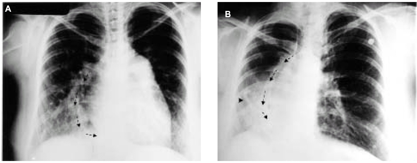 Clinical and Echocardiographic Characteristics of Scimitar Syndrome ...