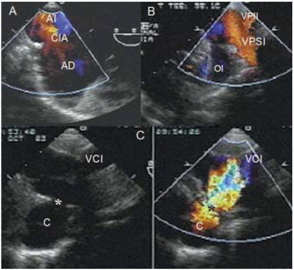 Clinical and Echocardiographic Characteristics of Scimitar Syndrome ...