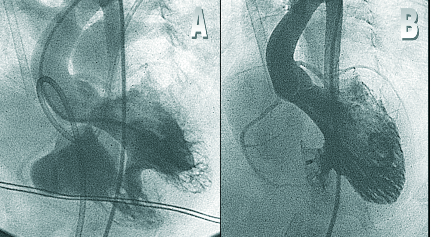 Percutaneous Transcatheter Closure of Ventricular Septal Defects Using ...