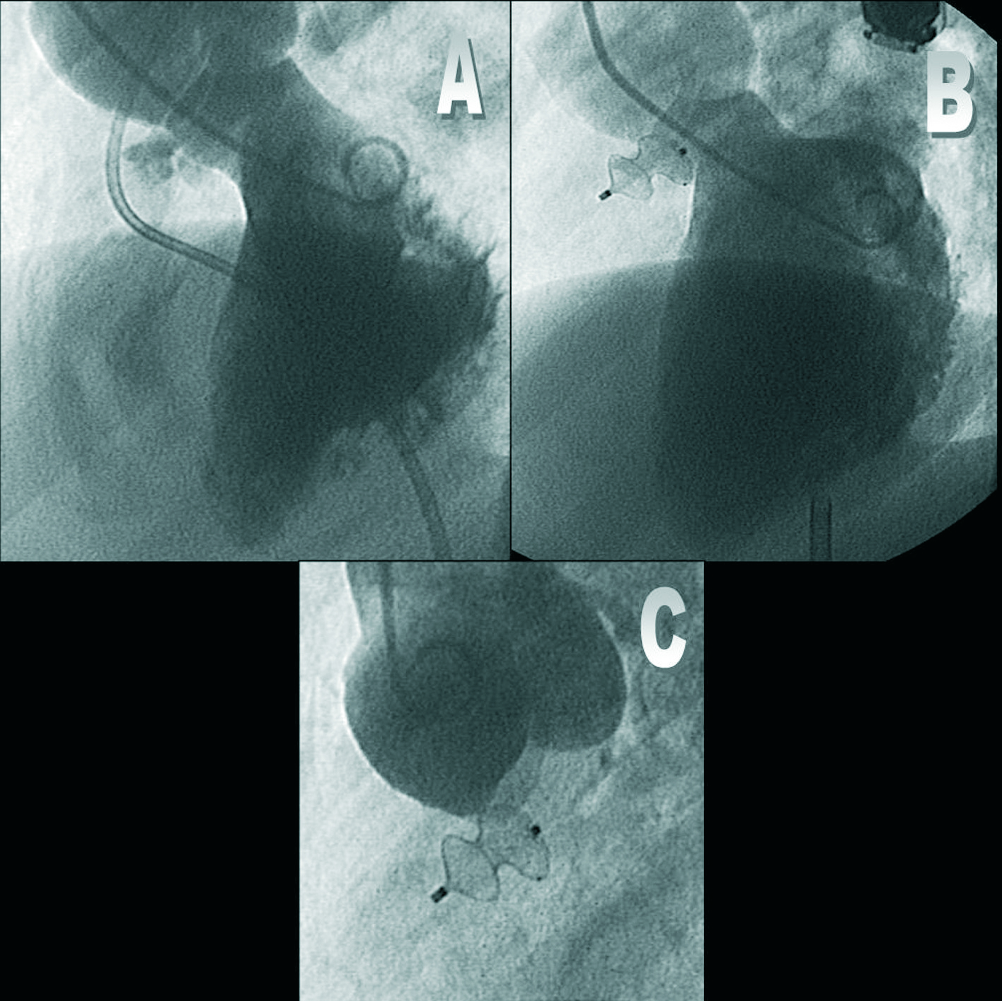 Percutaneous Transcatheter Closure of Ventricular Septal Defects Using ...