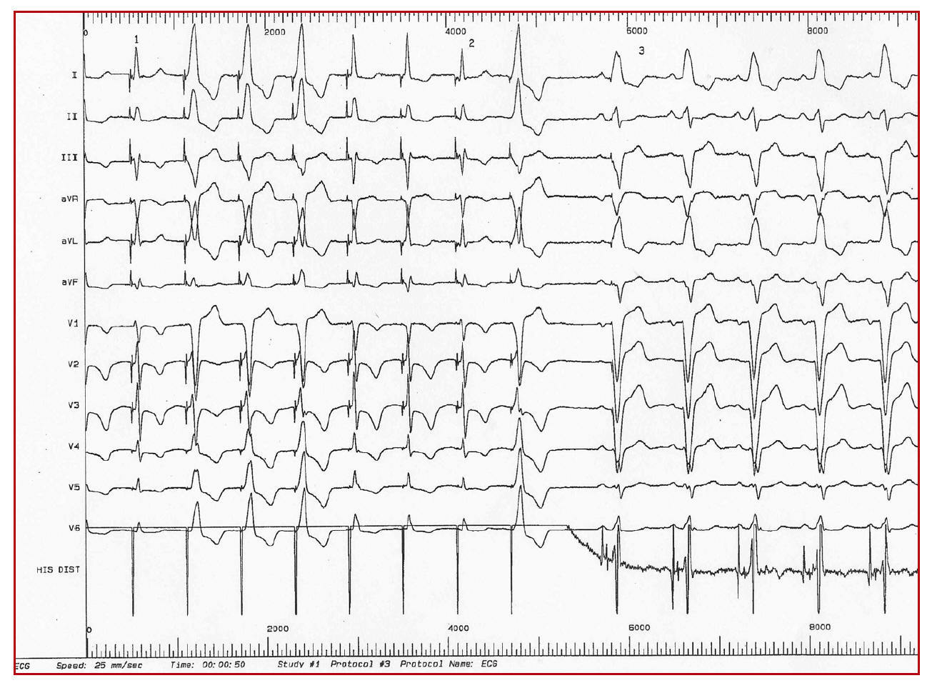 Permanent His-Bundle Pacing in Patients With Infra-Hisian ...