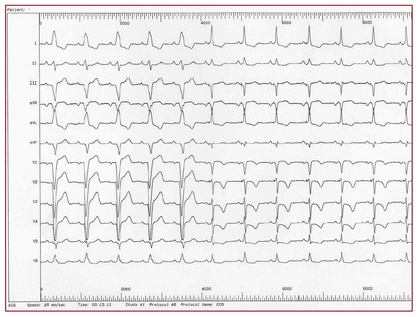 Permanent His-Bundle Pacing in Patients With Infra-Hisian ...