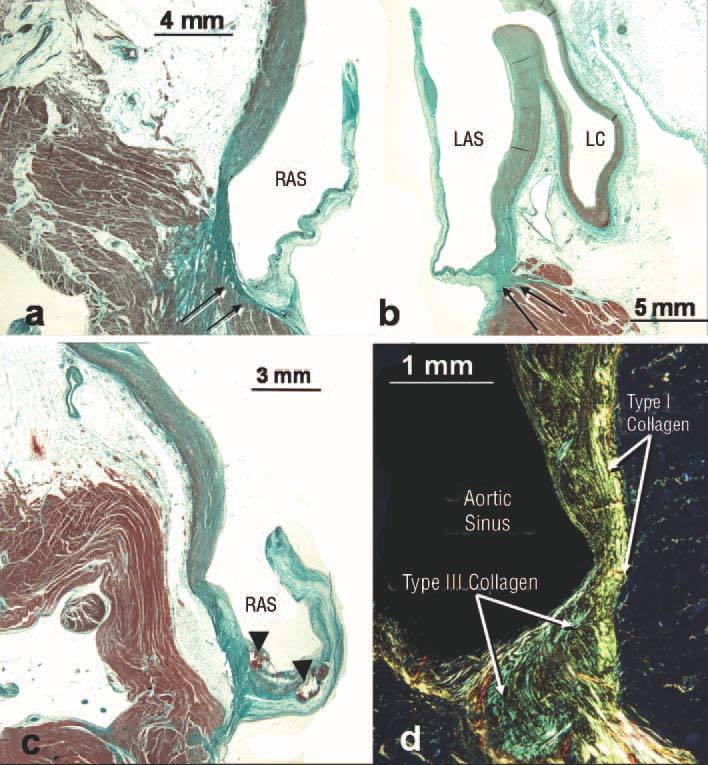 Structural Features of the Sinus of Valsalva and the Proximal Portion ...