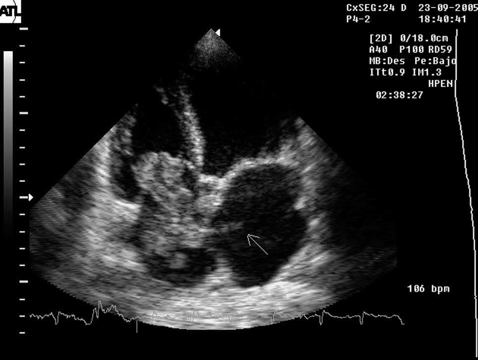 Thrombosis of Patent Foramen Ovale Treated by Oral Anticoagulation ...