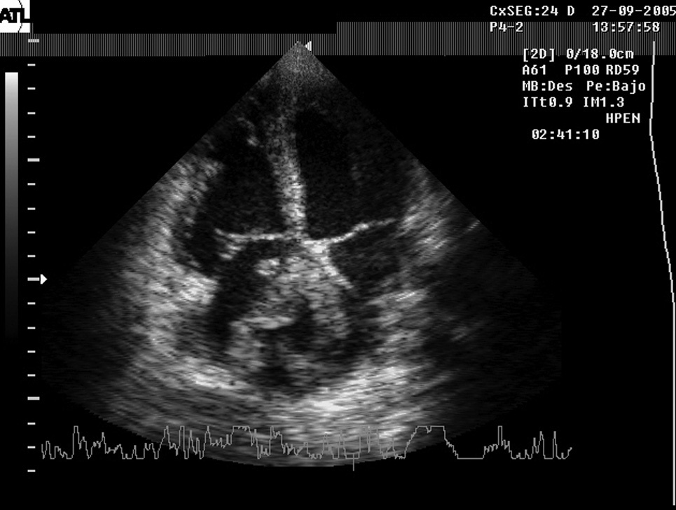 Thrombosis of Patent Foramen Ovale Treated by Oral Anticoagulation ...