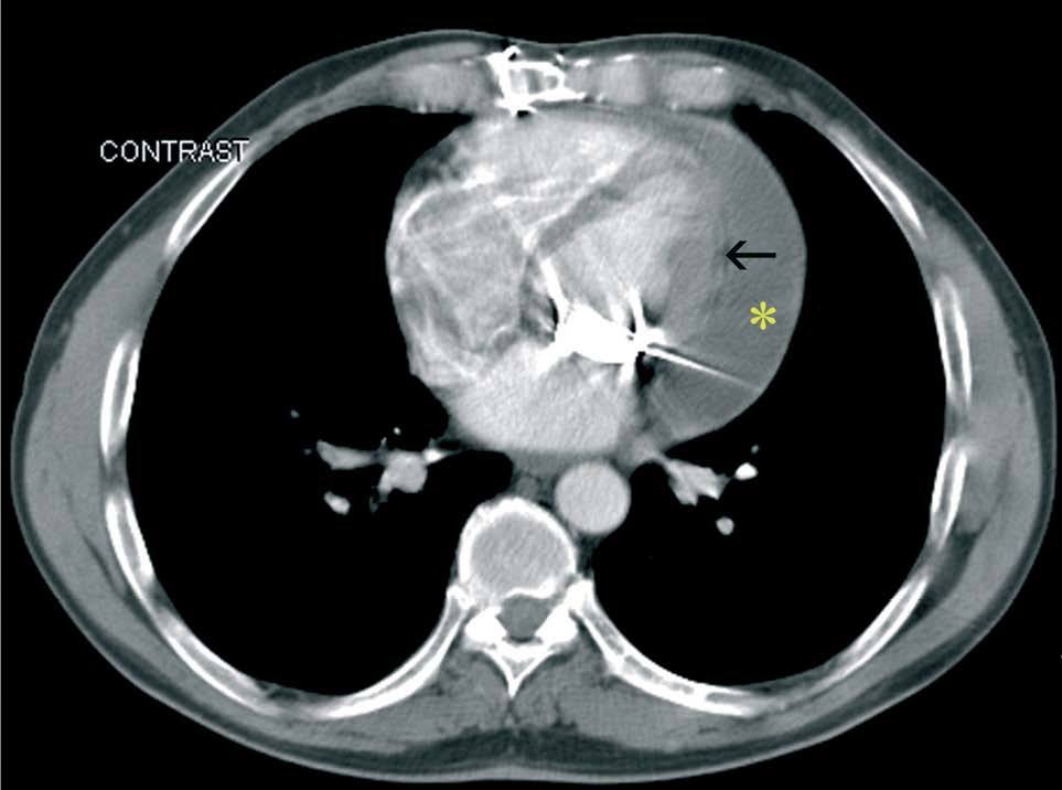 A Case of Idiopathic Effusive¿Constrictive Pericarditis | Revista ...