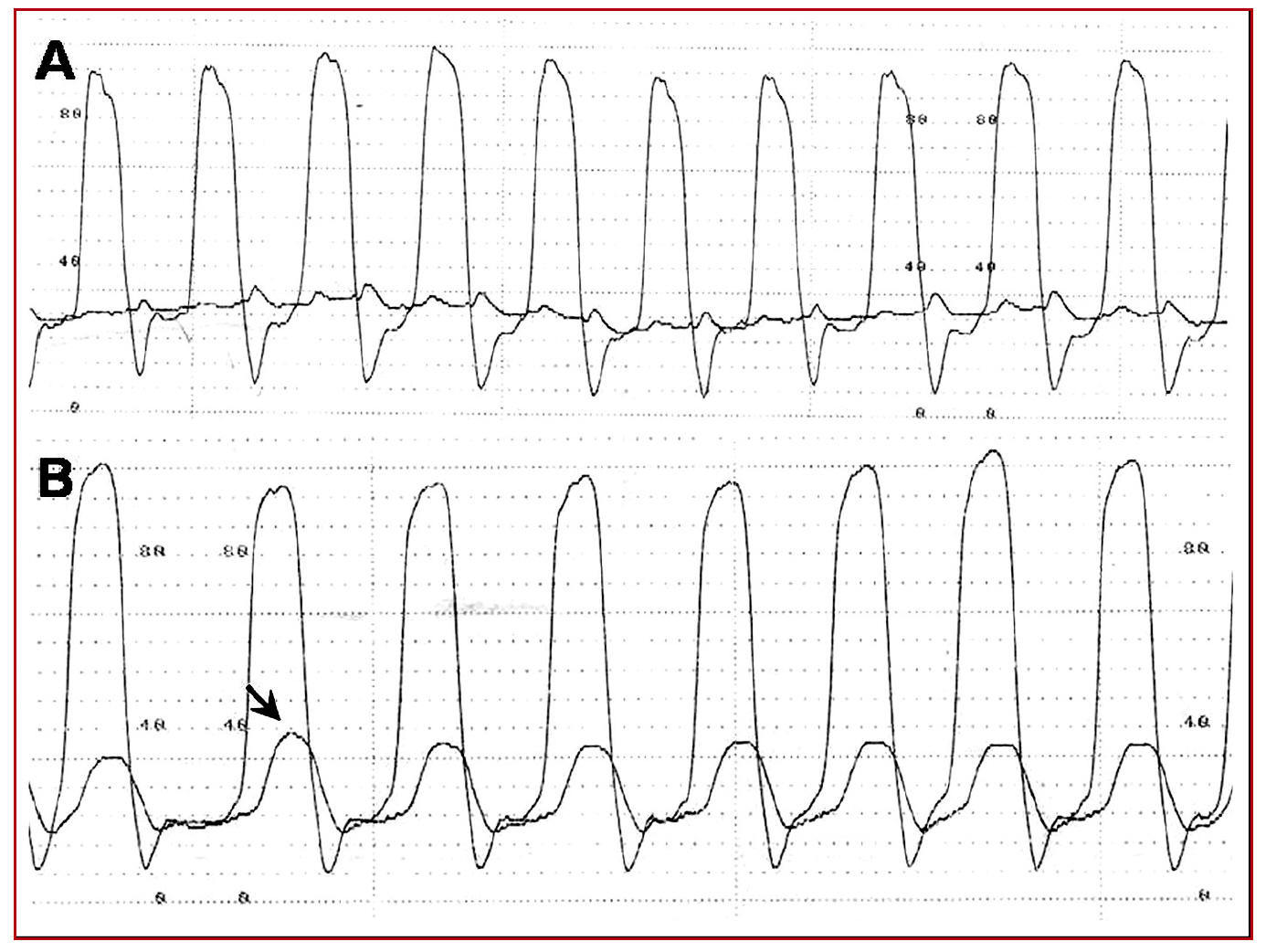 A Case of Idiopathic Effusive¿Constrictive Pericarditis | Revista ...