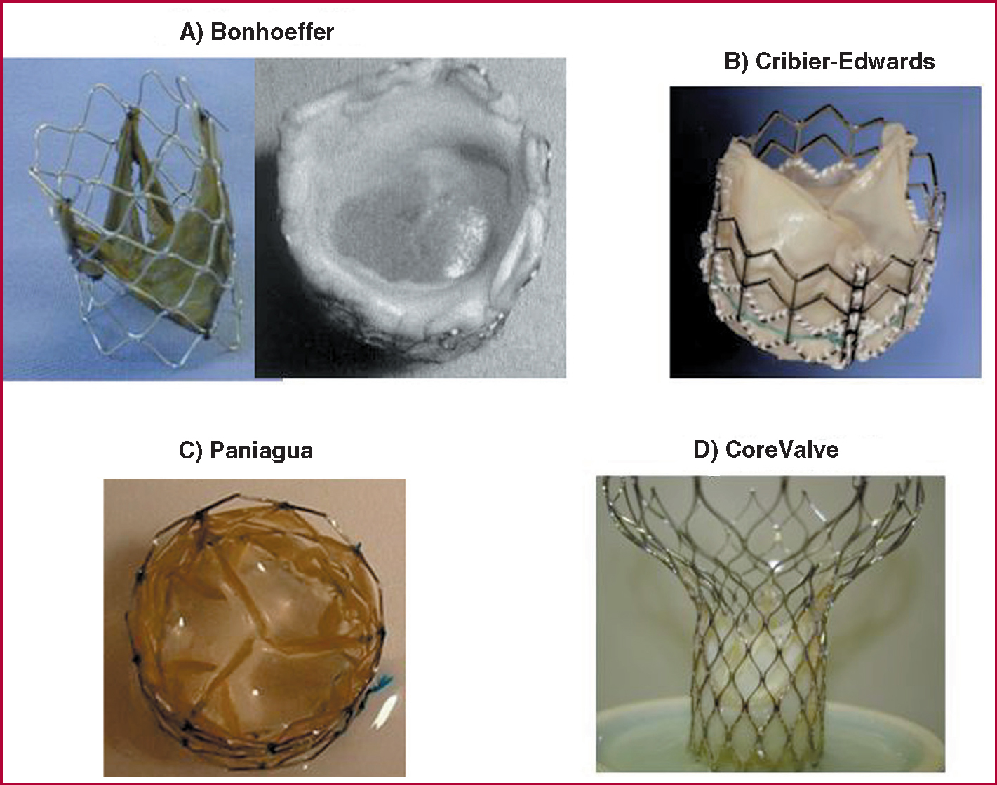 Percutaneous Treatment of Heart Valves | Revista Española de Cardiología