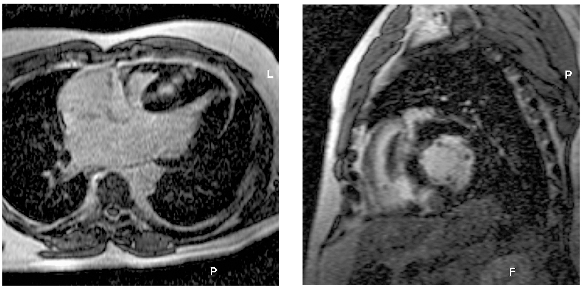 Clinical Significance of Late Gadolinium Enhancement on Cardiovascular ...