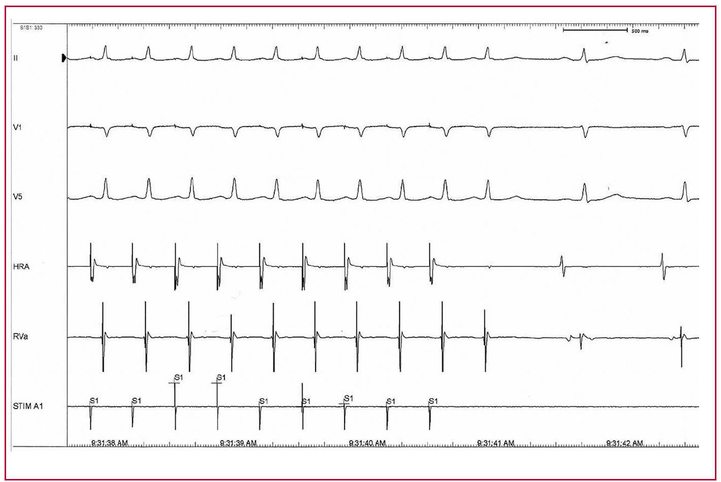 Usefulness of Incremental Atrial Pacing for Evaluating the ...
