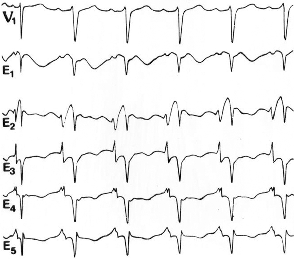 Acute Right Atrial and Ventricular Infarction | Revista Española de ...