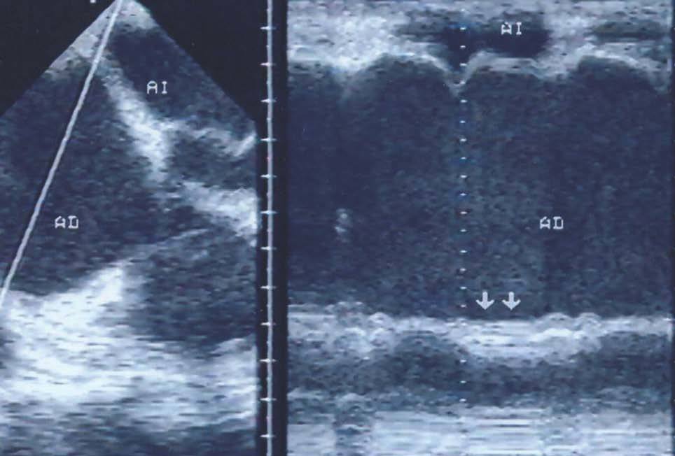 Acute Right Atrial and Ventricular Infarction | Revista Española de ...