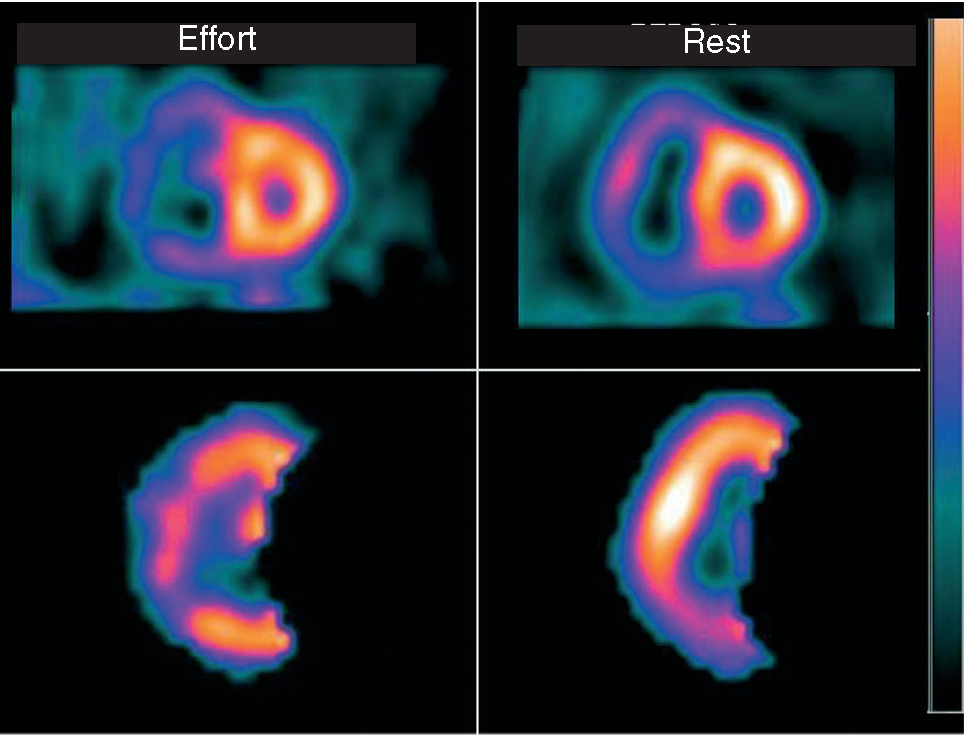 Acute Right Atrial and Ventricular Infarction | Revista Española de ...