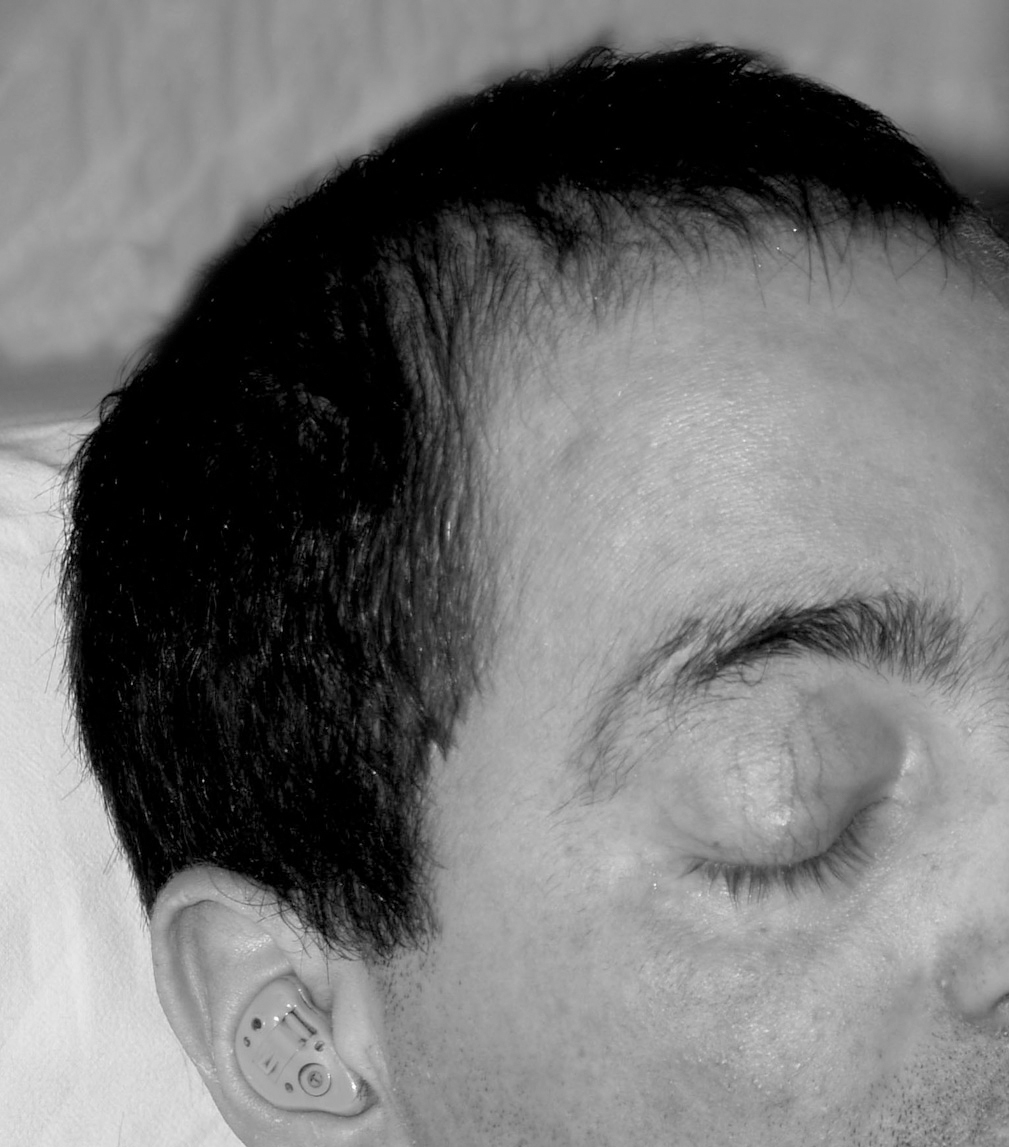 Kearns-Sayre Syndrome: Recurrent Syncope and Atrial Flutter | Revista ...