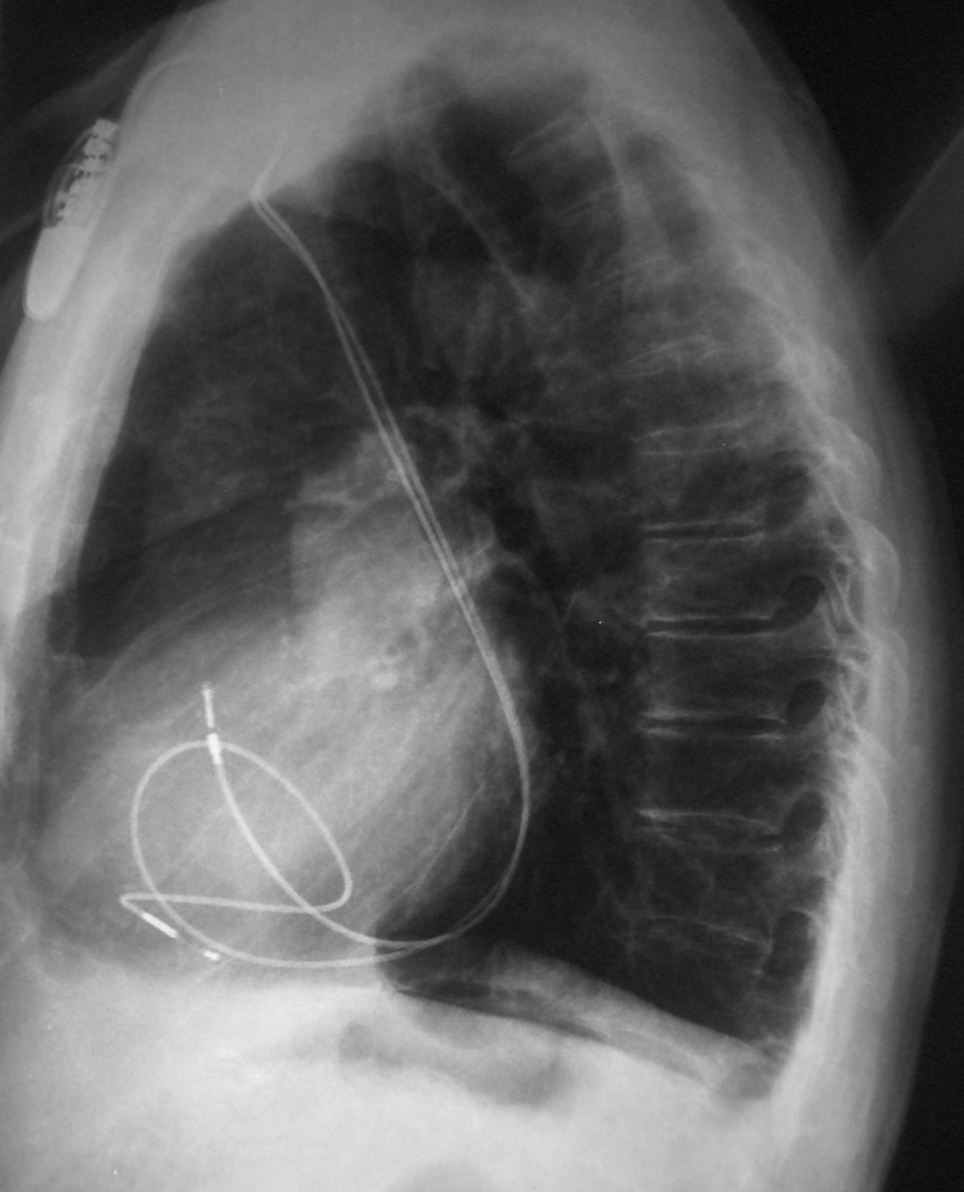 Pacemaker Implantation Via a Persistent Left Superior Vena Cava ...