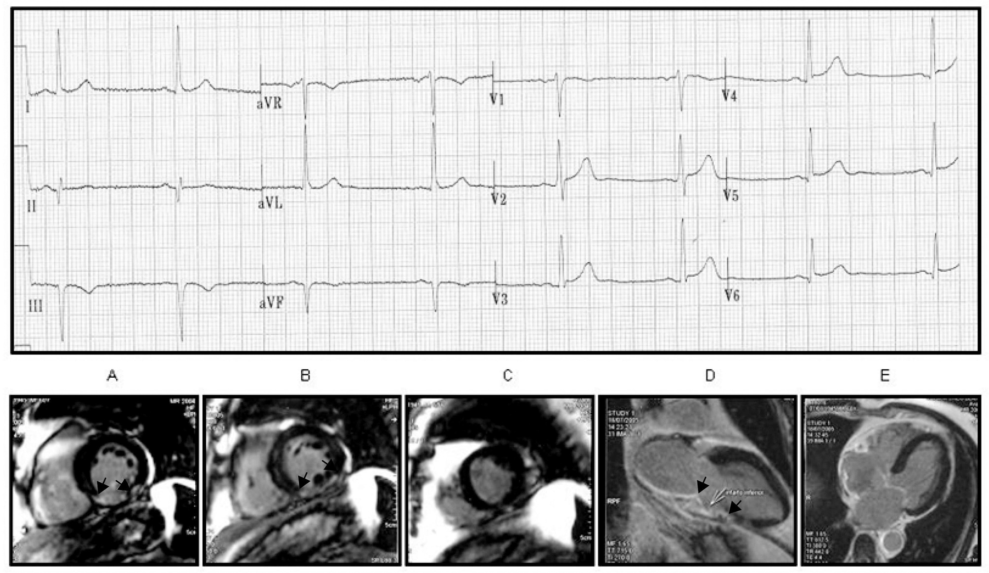 New Heart Wall Terminology and New Electrocardiographic Classification ...